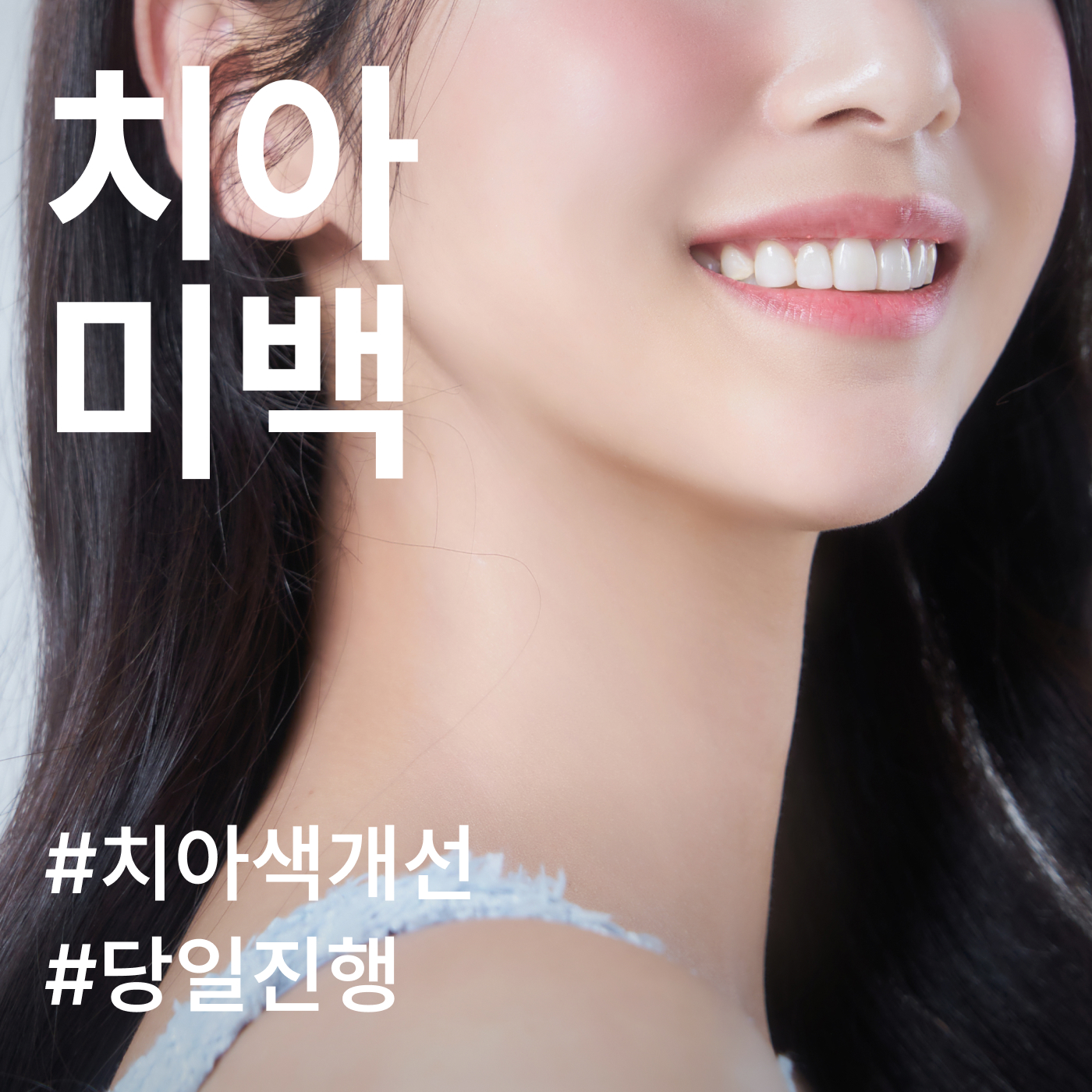 미소 밝은 오늘 치아미백 할인 가격 후기 전후 효과 정보 By 서울오늘치과의원 여신티켓 국내 1등 피부과 성형외과 플랫폼