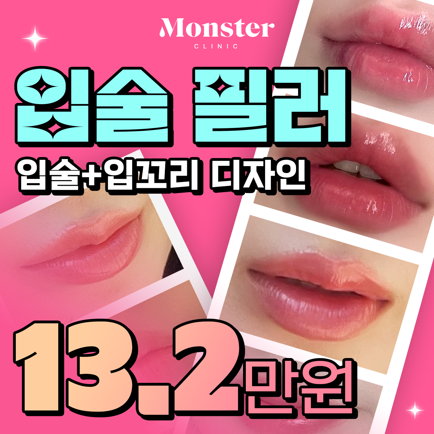 자연스러운 입술 입꼬리 필러 할인 가격 후기 전후 효과 정보 By 몬스터의원압구정점 여신티켓 국내 1등 피부과 성형외과 플랫폼