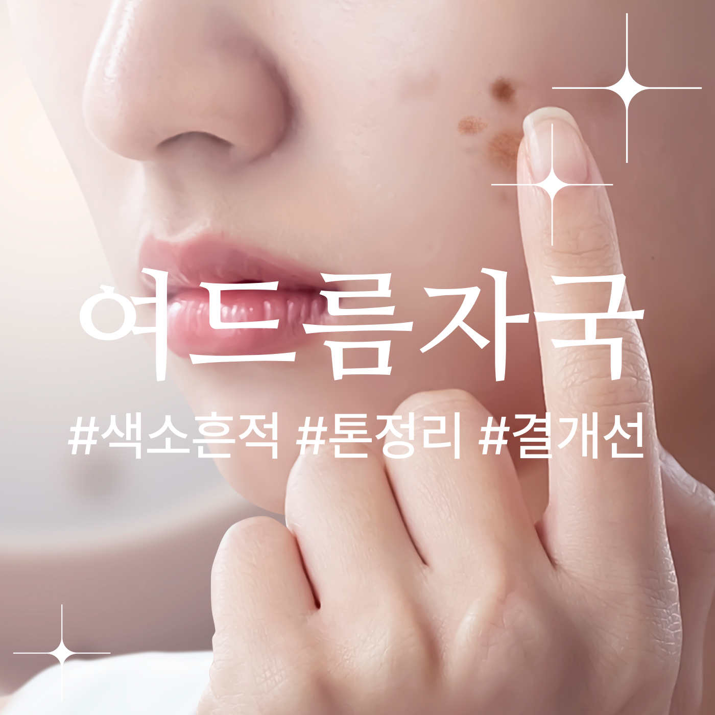 보기싫은 여드름흔적 할인 가격 후기 전후 효과 정보 By 해율한의원 여신티켓 국내 1등 피부과 성형외과 플랫폼